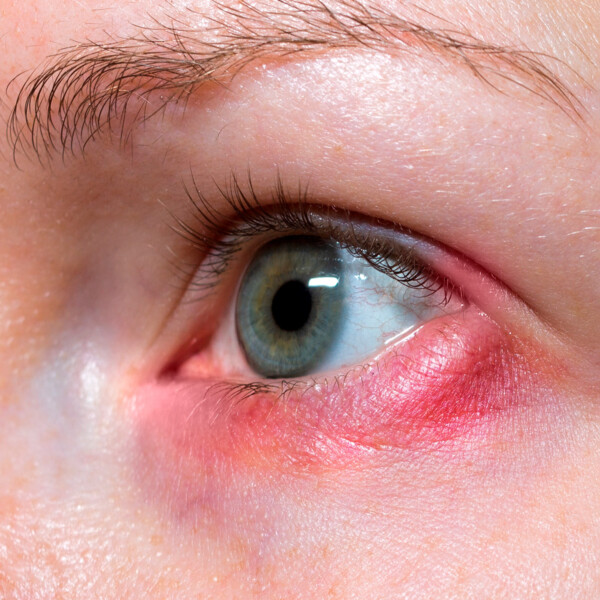 Enfermedades de los párpados – Eye Doctors