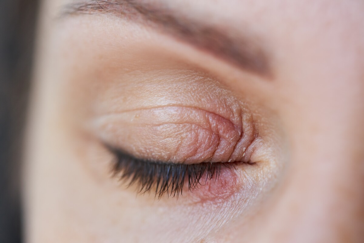 Cirugía Estética y Funcional de Párpados – Eye Doctors
